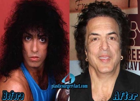 Paul Stanley's All Plastic Surgery Including Ear – Before and After ...